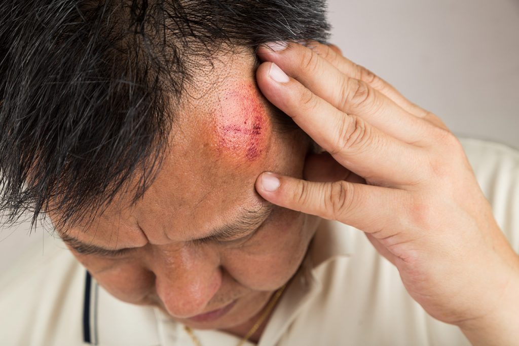 Bump On Head Cancer IFHNOS Auckland 2016 Australian Head Bump On Head Cancer IFHNOS Auckland 2016 Australian Head