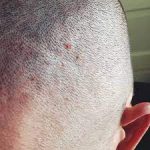 Dent in the head: Skull indentation Causes | IFHNOS Auckland 2016