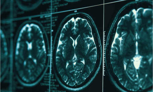The Dangers of a Depressed Skull Fracture: What You Need to Know