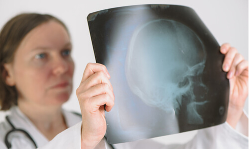 Skull Fracture Symptoms: What to Look For After an Injury